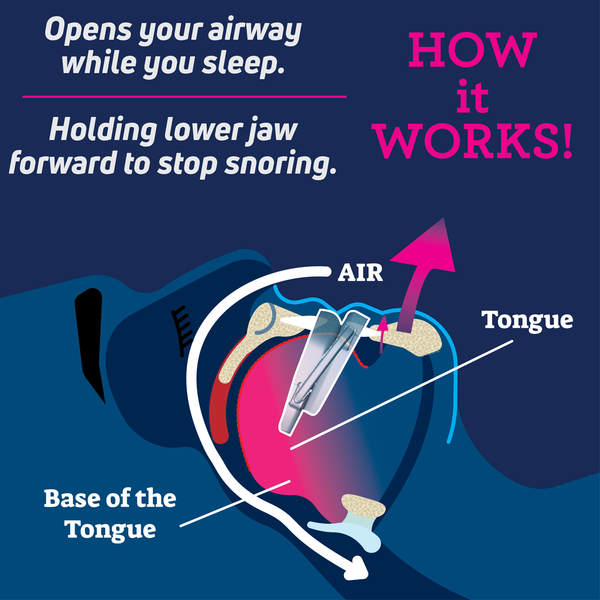 2 Pack SmartGuard Anti-Snore Device - SmartGuard RX